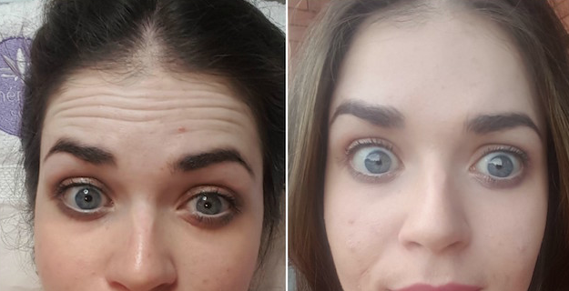 I Got Botox At 23. Here's What I Thought Of The Procedure And Why I ...