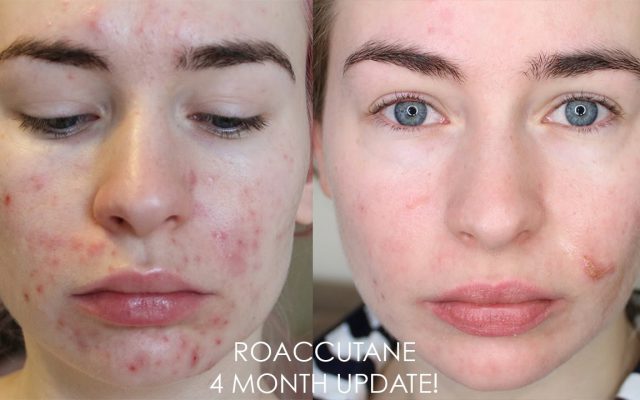 4 Common Beliefs About Acne Drug Roaccutane, Debunked | Stellar